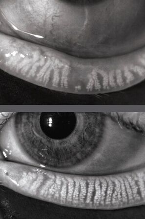 Meibomian Gland Dysfunction: The Hidden Cause of Dry Eye Syndrome and ...